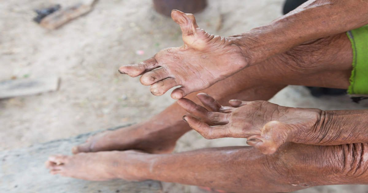 kushtarog symptoms: Kushtarog: कुष्ठ रोग के लक्षण और इलाज के बारे में ...