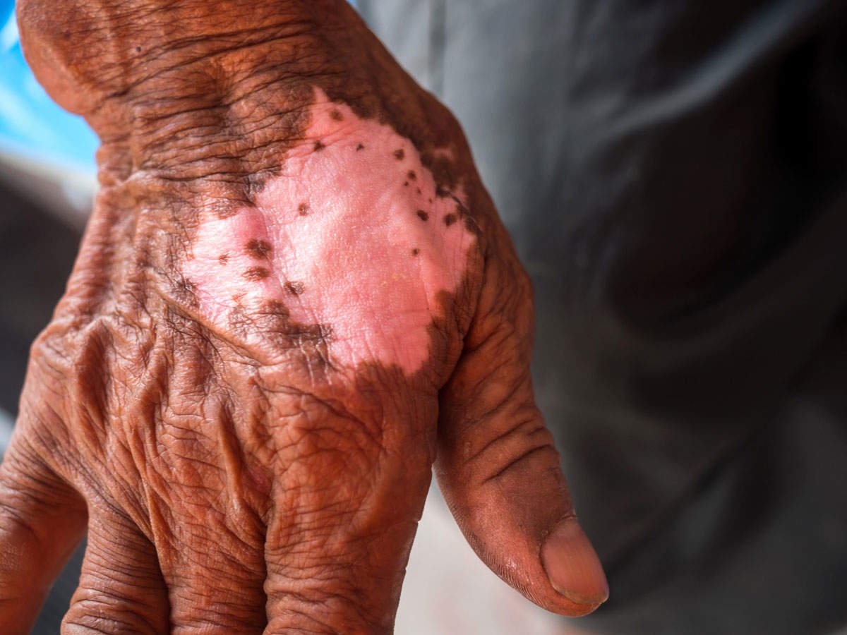 kushtarog symptoms: Kushtarog: कुष्ठ रोग के लक्षण और इलाज के बारे में ...