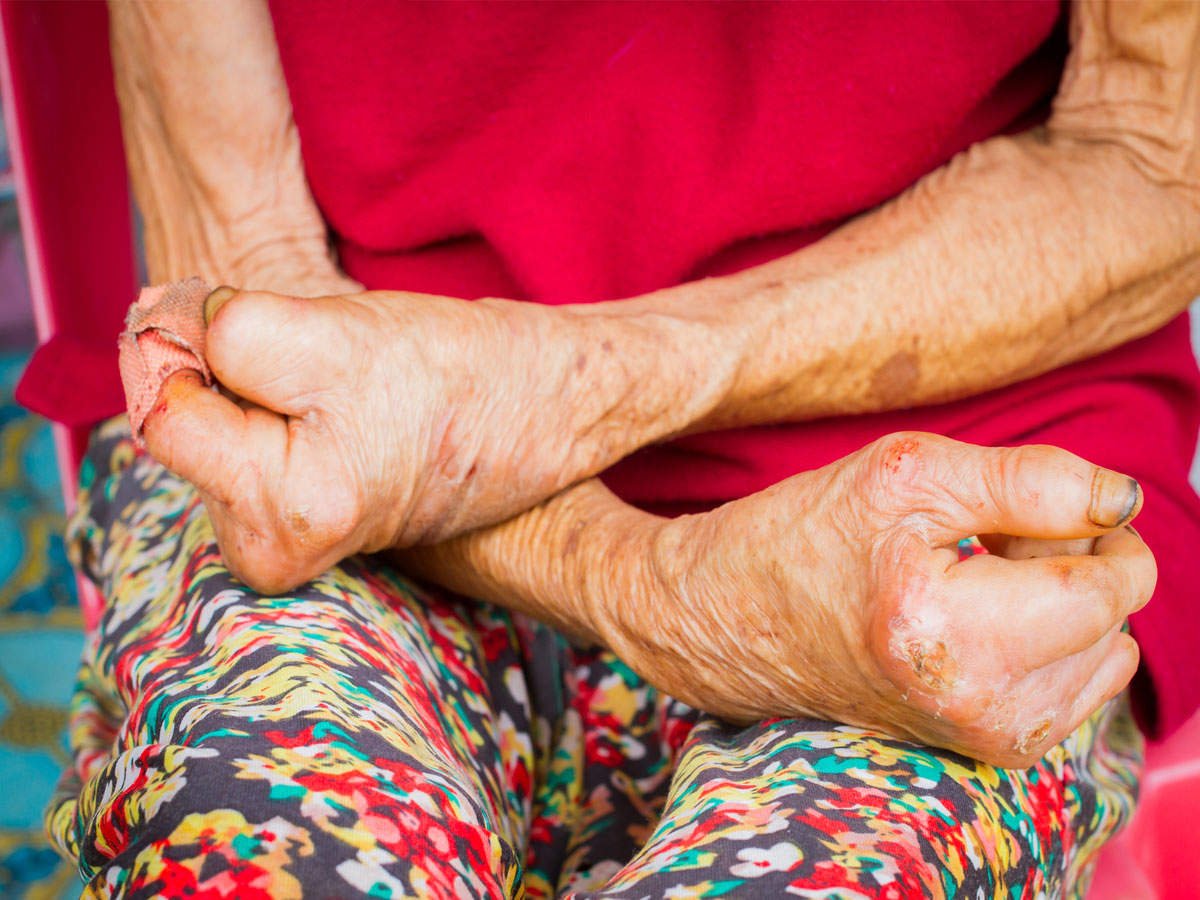 kushtarog symptoms: Kushtarog: कुष्ठ रोग के लक्षण और इलाज के बारे में ...